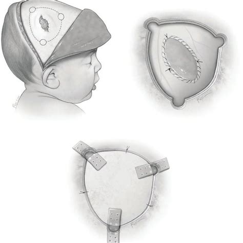 Calvarial Fracture Characteristics Download Scientific Diagram