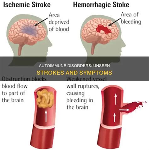Autoimmune Disorders Unseen Strokes And Symptoms Medshun