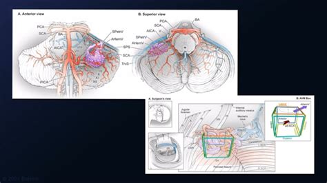 Microvascular Decompression Barrow Neurological Institute