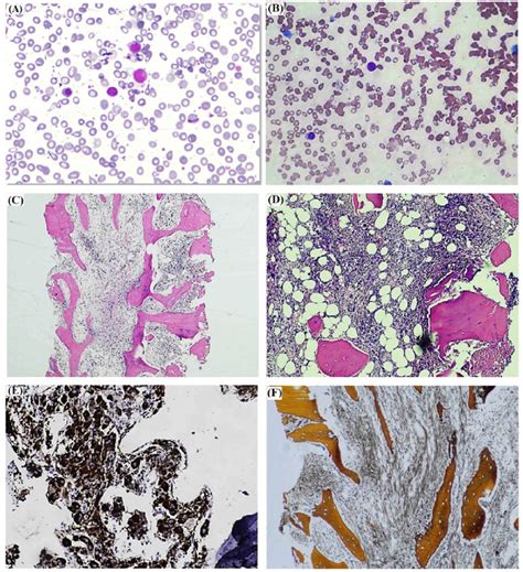 A Peripheral Blood Film 40x View Exhibiting Leucoerythroblastic