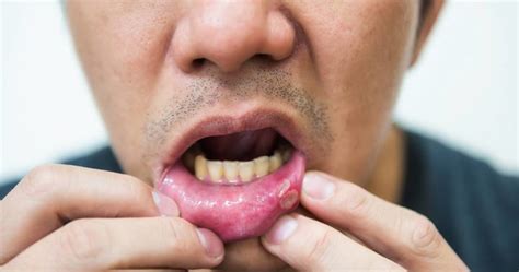 Кандидоз полости рта причины симптомы лечение и профилактика