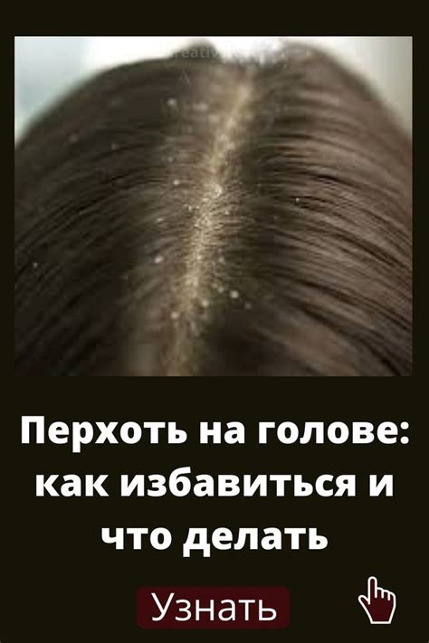 Как избавиться от перхоти в домашних условиях — Психология Hair Story