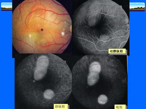 中心性浆液性脉络膜视网膜病变word文档在线阅读与下载无忧文档