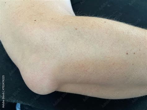 Olecranon Bursitis Is Sometimes Called Popeyes Elbow” Bursitis Is A