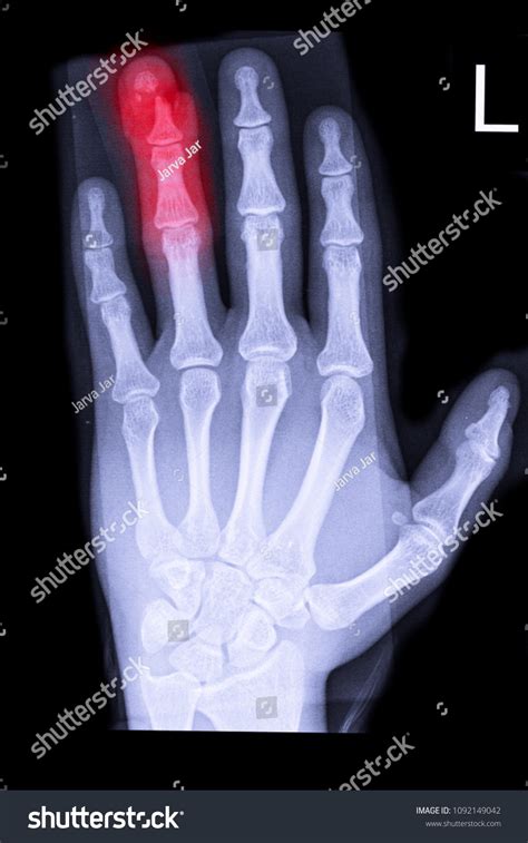 Broken Ring Finger X Ray
