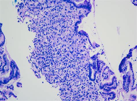 Poorly Differentiated Adenocarcinoma In Gastric Mucosa Hande X 100 Download Scientific Diagram