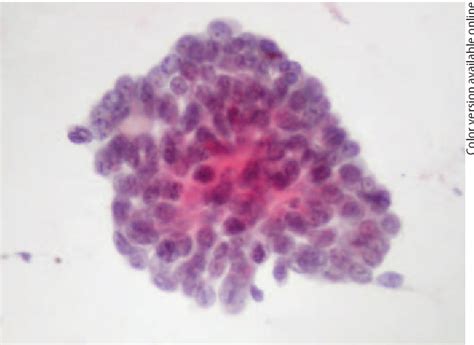 Figure 1 From Identification Of Atypical Glandular Cells In Pap Smears