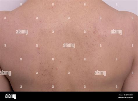 Close Up Bruises Broken Capillaries After Cupping Anti Cellulite