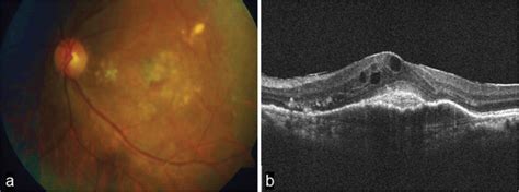 Managing Massive Submacular Hemorrhage Using Intravitreal Brolucizumab