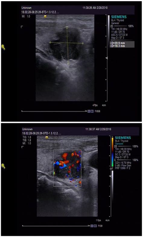 Ultrasound Evaluation Revealed That The Patient Had A 24 Mm × 18 Mm