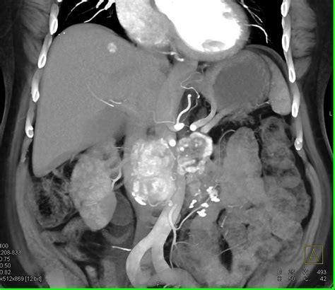 Neuroendocrine Tumor Small Bowel Radiology Case Studies Ctisus Ct