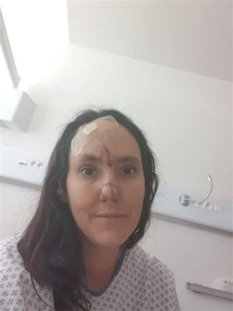 Laure Seguy Biography French Sunbather Suffers From Basal Cell Carcinoma