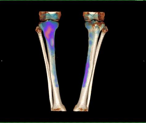Case Of The Week Tibial Stress Fracture And Medial Tibial Stress