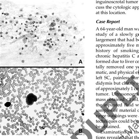 Histology A Neoplastic Proliferation Of Atypical Cells With High
