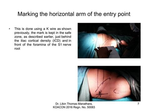 Technique Of Percutaneous Iliosacral Screw Fixation Of Sacroiliac Disruptions With The Patient