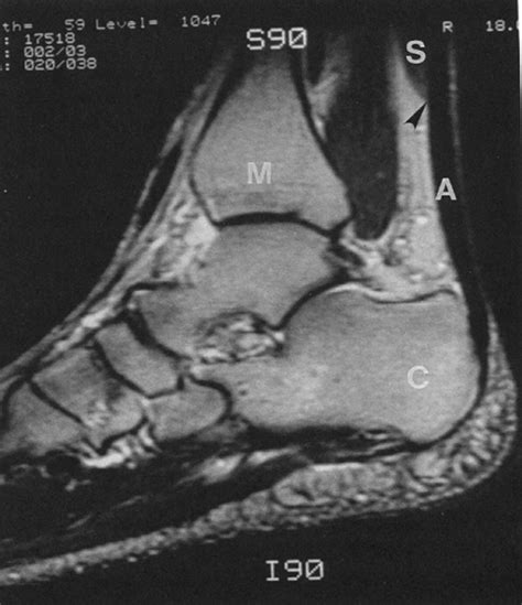 Locoregional Flaps In Lower Extremity Reconstruction Plastic Surgery Key