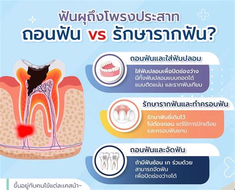 🦷 ลองมาดูวิธีรักษา เมื่อฟันผุถึงโพรงประสาท😵 ว่ามีอะไรบ้าง ถอนฟัน หรือ