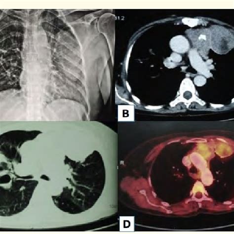 Pdf Primary Primitive Neuroectodermal Tumor Pnet A Rare Mediastinal Neoplasm In Elderly