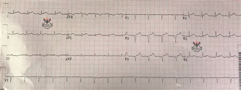 Ecg Basics And Fundamentals Criteria For Low Voltage Qrs Complexes And