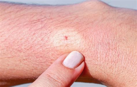 7 راهکار کاربردی برای درمان نیش زنبور در خانه • دیجی‌کالا مگ