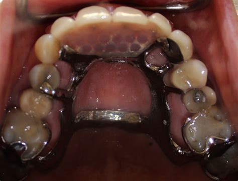 Upper Partial Denture