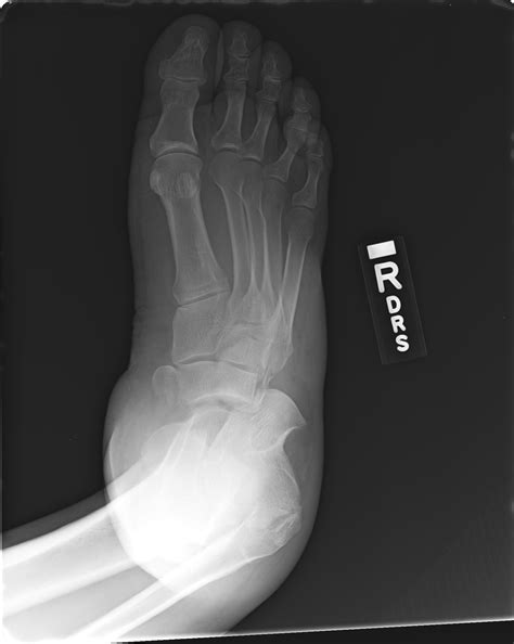 Foot Fracture Buyxraysonline Foot Fracture Buyxraysonline