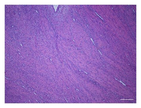 Histological Presentation Of The Lesions Described Leiomyoma A B C