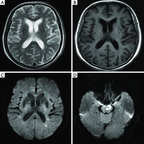 A Year Old Male Patient S Head MRI On The Day After Admission A D Download Scientific