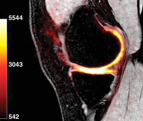 Articular Cartilage In The Knee Current MR Imaging Techniques And