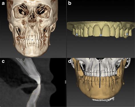 Why Cbct Cone Beam Ct Scan Is A Must For Patients 43 Off