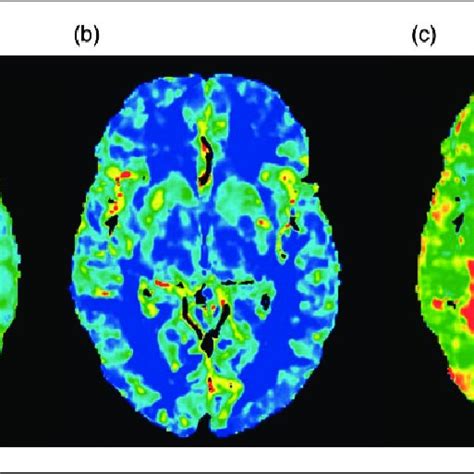 Electroencephalographic Findings In Patient 1 Left Temporal