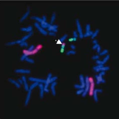 Pdf Interstitial Deletion Of The Distal Long Arm Of Chromosome 4 Del 4q33 Q35 In