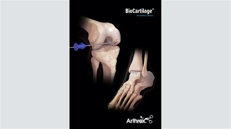 Arthrex Biocartilage® Extracellular Matrix