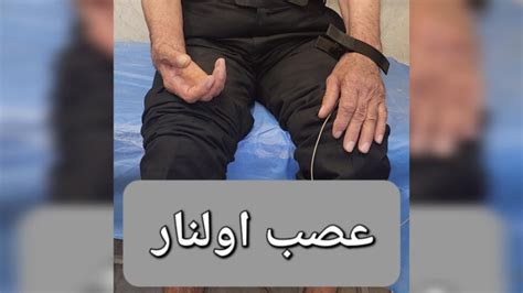 درگیری عصب اولنار اولنار نوروپاتی