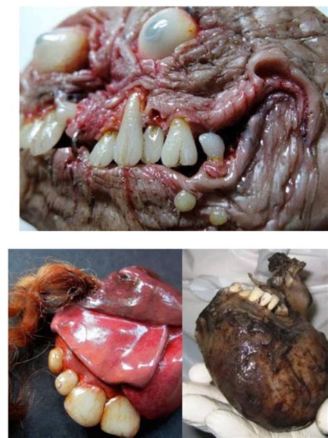 ¿qué Es Un Teratoma El Raro Tumor Al Que Le Puede Salir Dientes