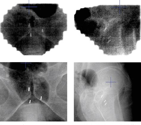 Figure 1 From Electronic Portal Imaging Vs Kilovoltage Imaging In Fiducial Marker Image Guided