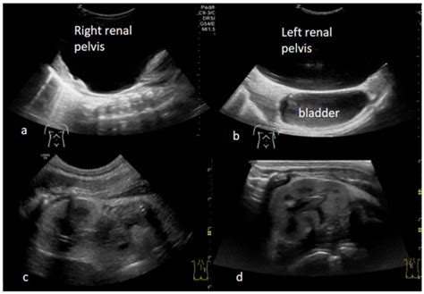 Giant Bilateral Hydronephrosis In A Newborn—a Case Report Pmc
