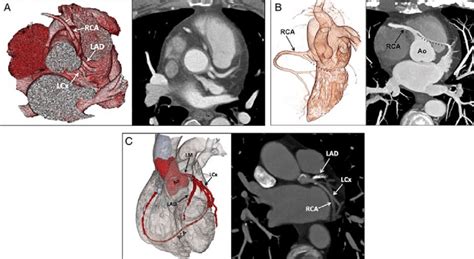 A Separate Lad And Lcx Origins A 47 Year Old Man Presenting With Download Scientific Diagram