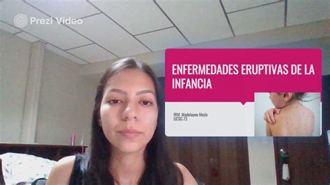 Enfermedades Eruptivas De La Infancia By Madelayne Mejía On Prezi Video