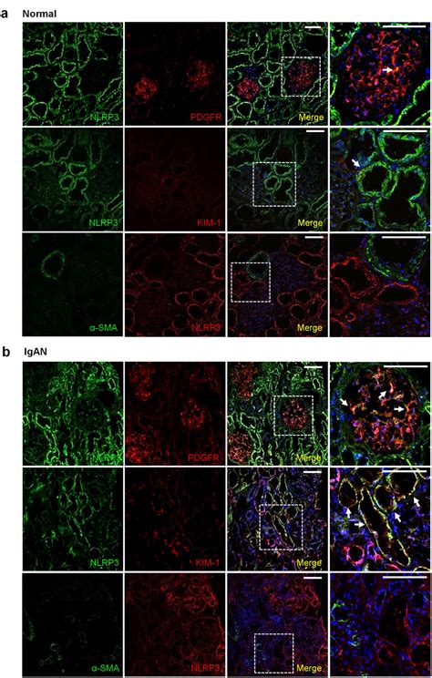 nlrp3 expression in human igan immunofluorescence confocal microscopy