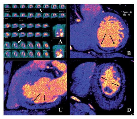 Usefulness Of Integrated Dual Source Multislice Computed Tomography And Cardiac Spect In A