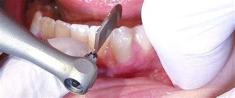 Why IPR Should Be Avoided At The Beginning Of Clear Aligner Treatment