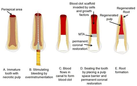 Regenerative Endodontic Therapy News Dentagama