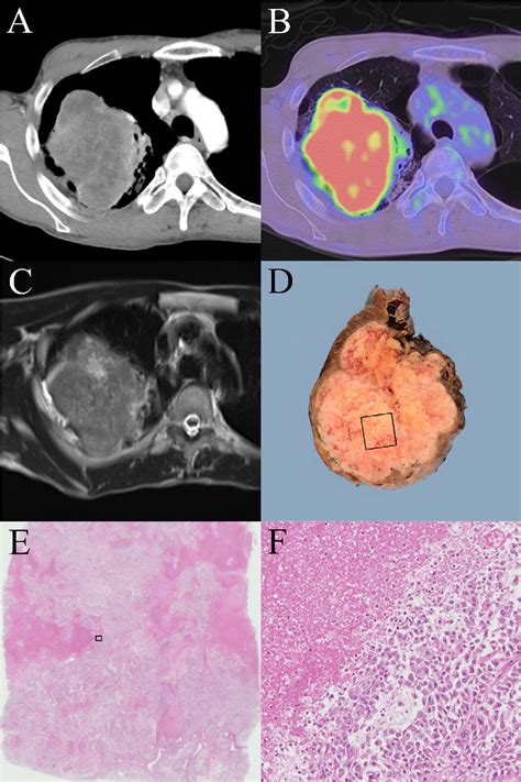 Figure 1 From Proton Magnetic Resonance Spectroscopy Of Lung Cancer In