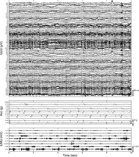 Simultaneous Scalp Electroencephalography EEG Electromyography EMG And Whole Body