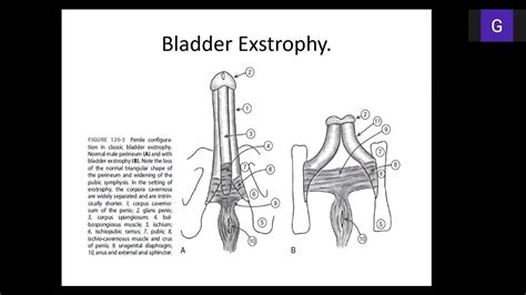 Bladder Exstrophy Dr Mzwandile Jula Expert Comments By Prof S Shaik