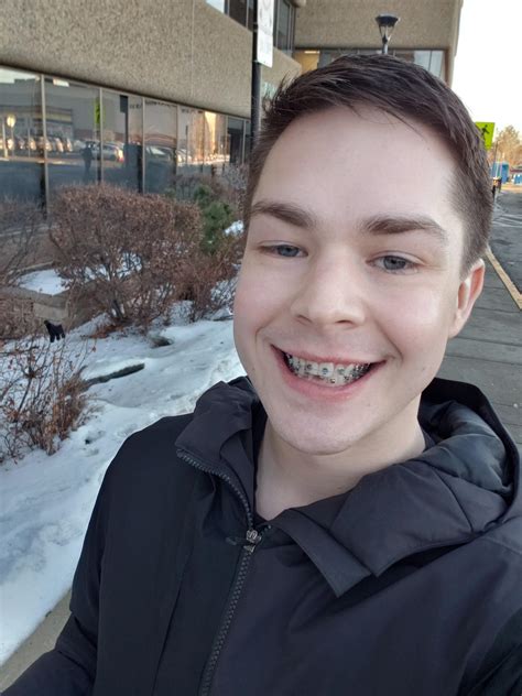 Anyone Using The Brius Lingual Braces Rbraces