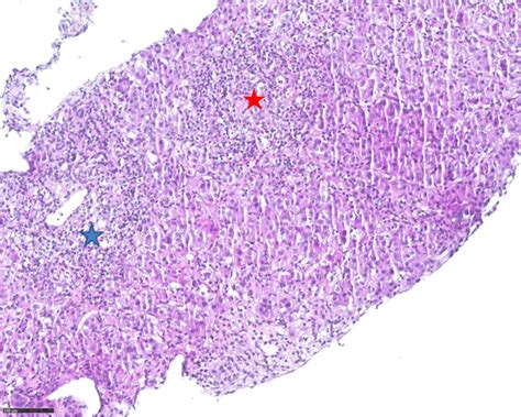 Histology With Hematoxylin‐eosin‐saffron Staining Polymorphic Download Scientific Diagram