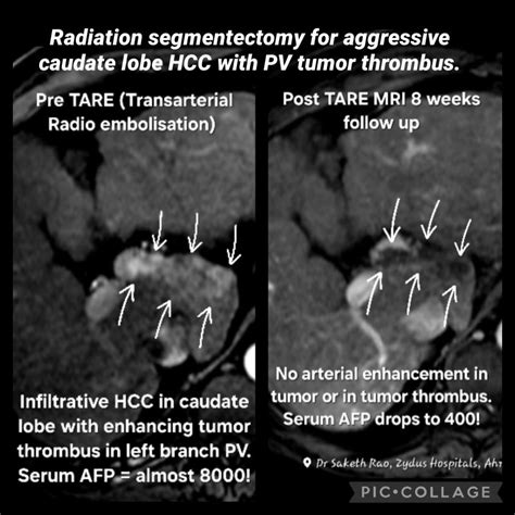 Saketh Rao On Linkedin Tare Transarterial Radio Embolisation Is A