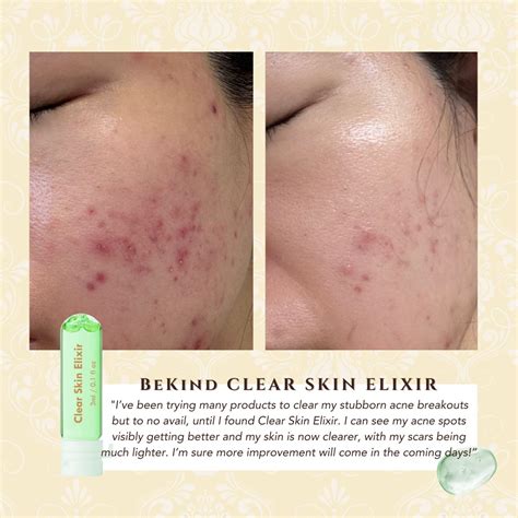 Clear Skin Elixir 3ml Bekind